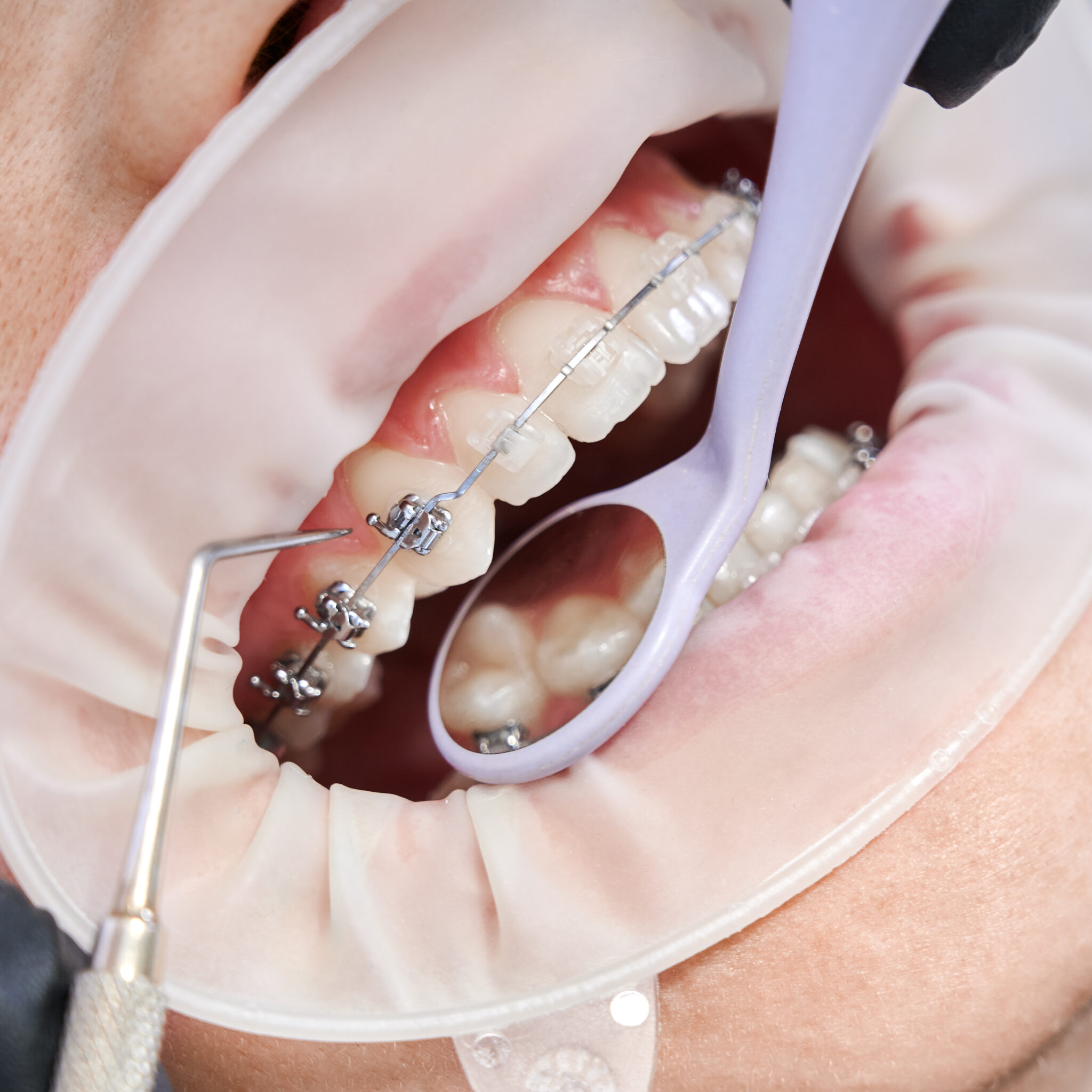 Traditional Metal Braces – Teller Dental: Emergency & General Dentistry